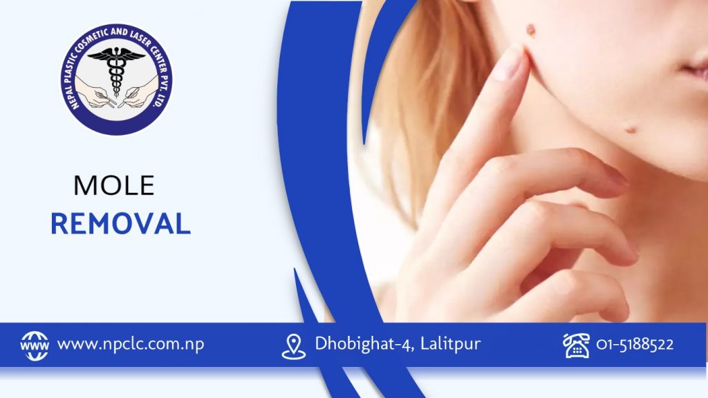 Mole| birth mark|naevus removal in Kathmandu Nepal -Non Surgical Way